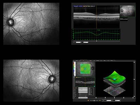 Uso de OCT en el Diagnóstico del Glaucoma: Ventajas y Evaluación ...